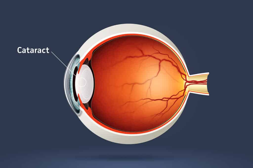 Cataract Treatment & Surgery in St. Louis, MO - STL Vision